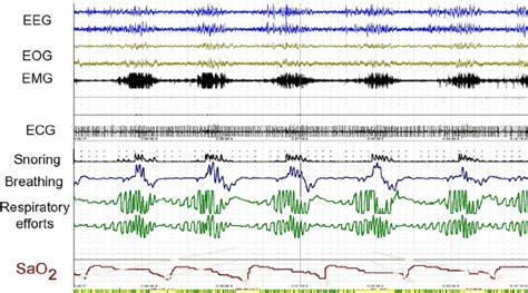 Patient S Psg Recording Abbreviations Ecg Electrocardiography Download Scientific