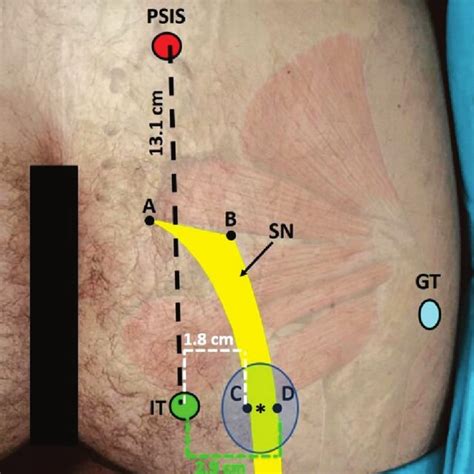 Compared Sciatic Blockage Techniques With Asterisk Showing The Needle