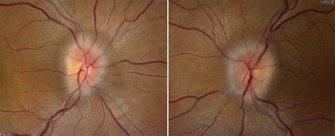 Inpatient And Emergency Consultations For Papilledema Increasing