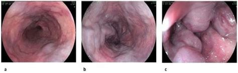 Diagnostics Free Full Text Diagnosis And Management Of Esophagogastric Varices