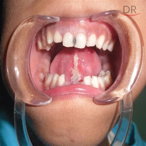 Lingual Frenectomy Using Diode Laser A Case Report