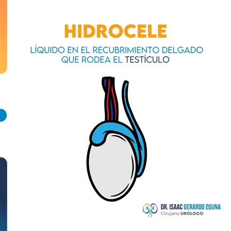 Un Hidrocele Es Un Tipo De Urologo Isaac Gerardo