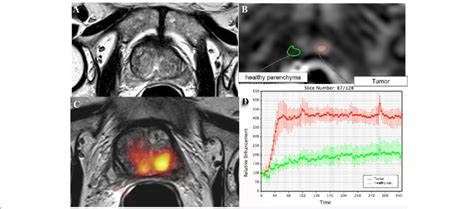 Dce Mri A B C With Time Intensity Curve D For Tumor Area And