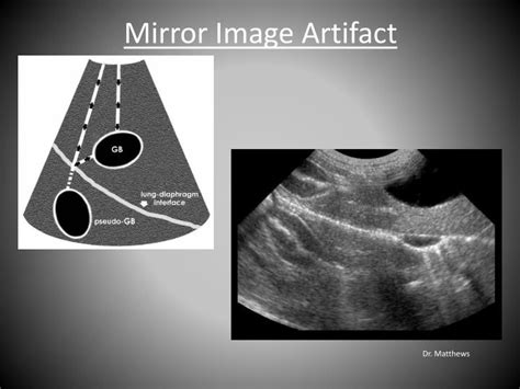 What Is Mirror Image Artifact In Ultrasound At Amelia Woodhouse Blog