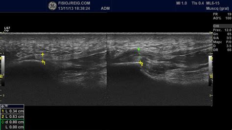 Fascitis Plantar Tratamiento Y Síntomas