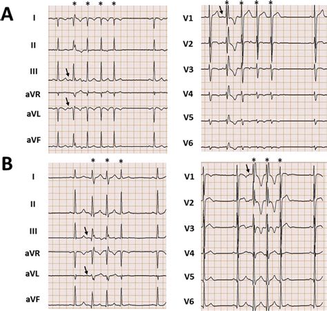 A Sinus Rhythm And Premature Atrial Contractions Pacs On Standard
