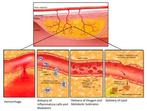 Effect Of Neovascularisation On The Plaque Morphology References Wafa