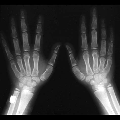 School Ager With Short Stature Pediatric Radiology Case Pediatric Imaging Pedsimaging