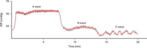 Icp Waveforms Abc Waves