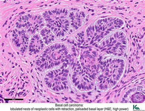 Nbme 17 Actinic Keratosis Nbme Answers