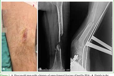 Figure 1 From Masquelet Technique For The Treatment Of Infected Segmental Long Bone Defects