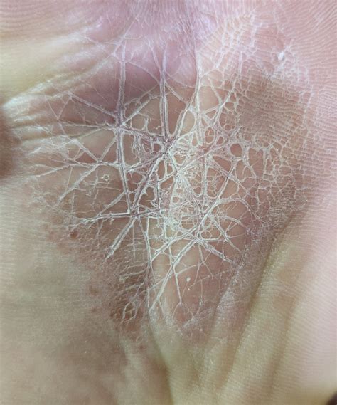 발 무좀 습진 지식in