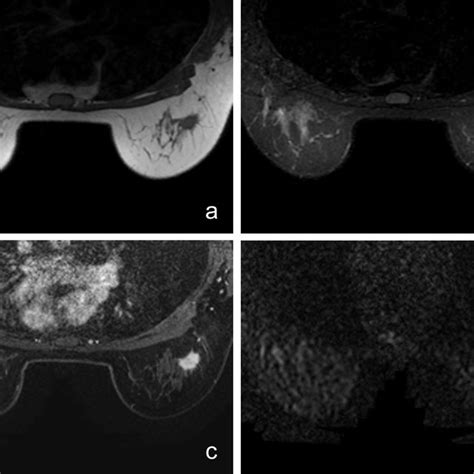Hemorrhagic Thyroid Cyst A And B Axial T1 And T2 Weighted Mr Images