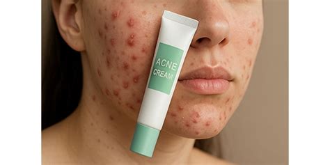 بهترین کرم ضد جوش و جای جوش مجله داروکده