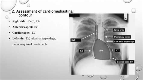 Approach To Cxr Pptx