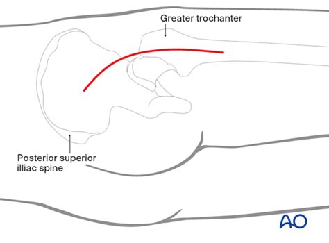 Total Hip Arthroplasty For Femoral Neck And Head Fractures With Hip Dislocation