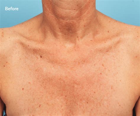 Sun Damaged Skin Colorado Dermatology Institute