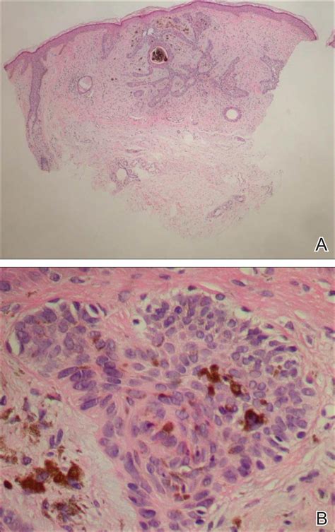 Linearly Curved Blackish Macule On The Wrist Mdedge Dermatology