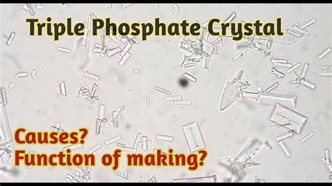 Triple Phosphate Crystals In Urine Crystals In Urine Microscopy Youtube