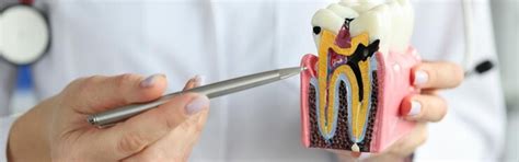 Double Root Canal On The Same Tooth Causes Symptoms And What To Expect