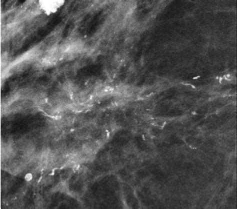 Calcifications At Digital Breast Tomosynthesis Imaging Features And