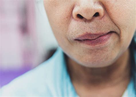 Bells Palsy Symptoms Causes And Treatment Burjeel Hospital
