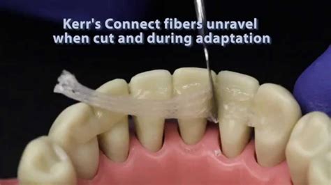 Ribbond Bridge Dental Code At Tammy Howland Blog