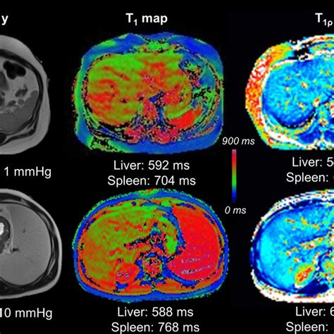 47 Year Old Female With Autoimmune Cholangiopathy And Mild Fibrosis F1