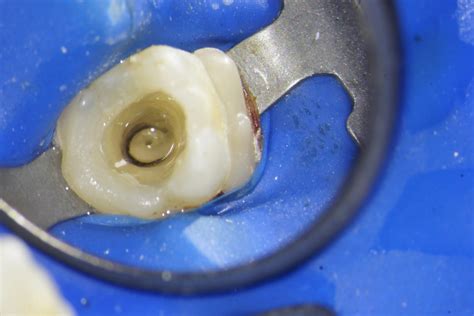 Зъб в зъба и лечение на гранулом