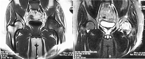 Magnetic Resonance Imaging Shows Characteristic Synovial Process With