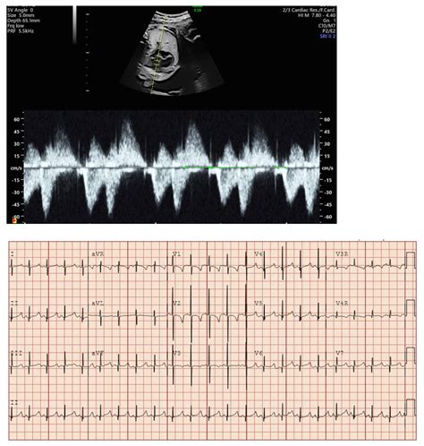 Diagnosis And Management Of Fetal Arrhythmias In The Current Era