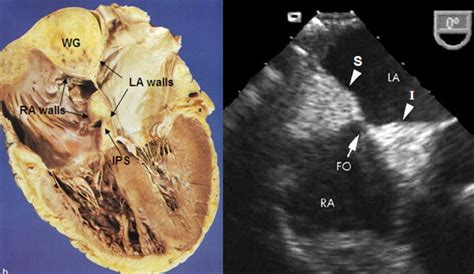 Lipomatous Hypertrophy Of The Interatrial Septum Revisited Journal Of