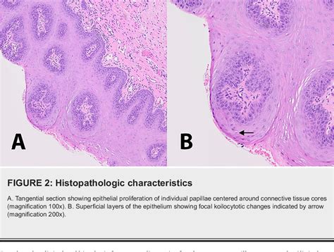 Figure 2 From Oral Squamous Papilloma Mimicking Oral Verrucous