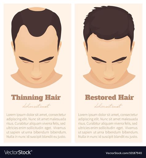 Male Pattern Baldness Design Template Royalty Free Vector Male Pattern Baldness Design Template Royalty Free Vector