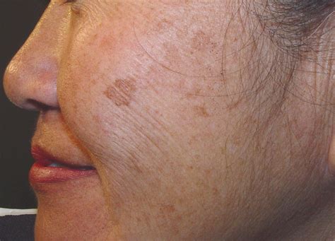 Hyperpigmentation Causes Risk Factors Treatment Options