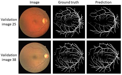 Deep Learning Architectures For Diagnosis Of Diabetic Retinopathy