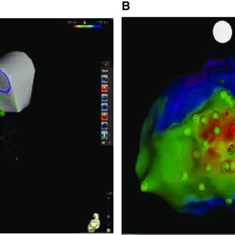 A Electroanatomic Bipolar Map With Evidence Of Posterior Basal Download Scientific Diagram