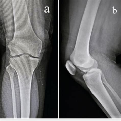 Mri Of Left Knee Shows Diffuse Nodular Synovial Hypertrophy In T2w A