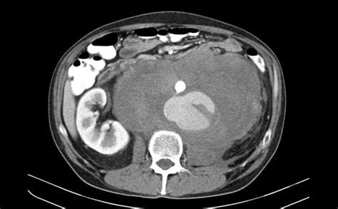 Ct Scan Showed Active Extravasation Of Contrast Agent Into Download Scientific Diagram