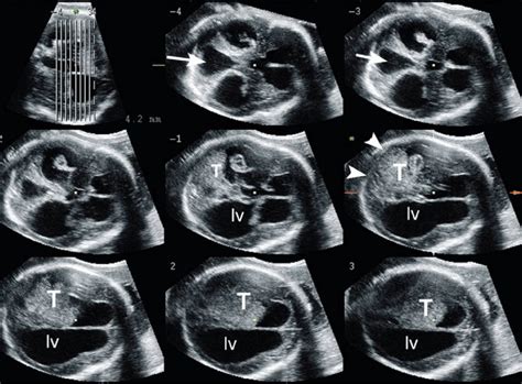 36 Tomographic Ultrasound Imaging Carcinoma Of The Right Choroid Download Scientific Diagram
