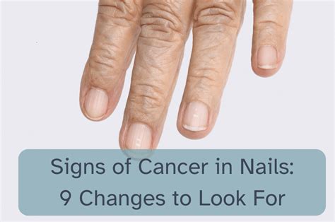 Subungual Melanoma Early Treatment