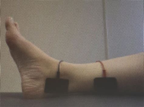 Tens Tibial Nerve R Prematureejaculation