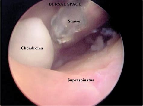 Subacromial Arthroscopic View Download Scientific Diagram