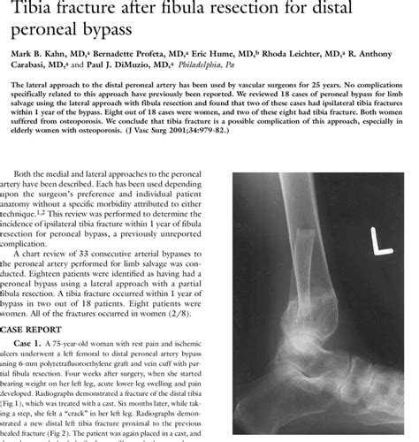 Transverse Fracture Of The Distal Tibia Download Scientific Diagram