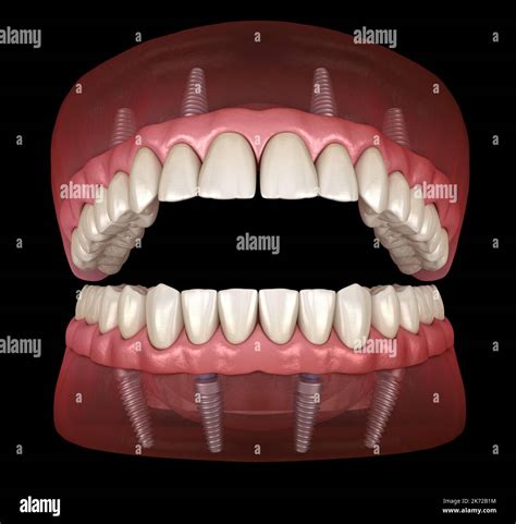Maxillary And Mandibular Prosthesis With Gum All On 4 System Supported By Implants Medically