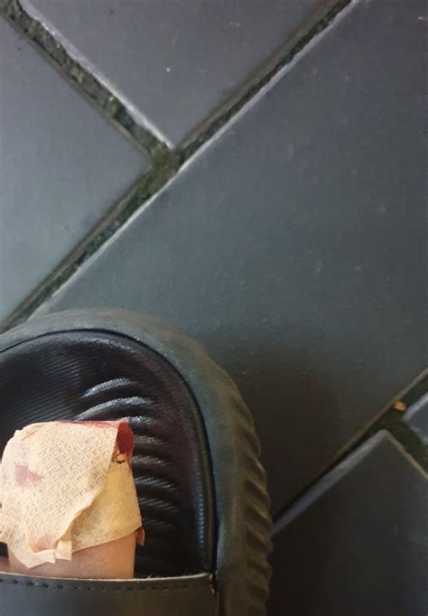 약혐 세게 부딧힌걸로 발톱이 뽑힐 수도 있음 해외축구 에펨코리아