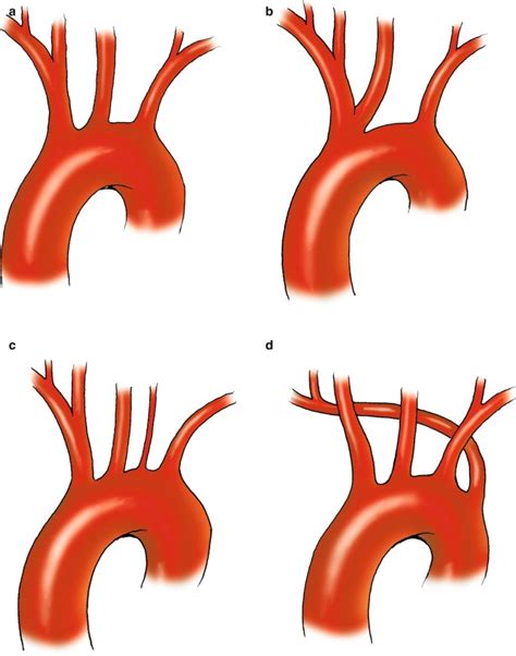 Essential Neurovascular Anatomy Springerlink