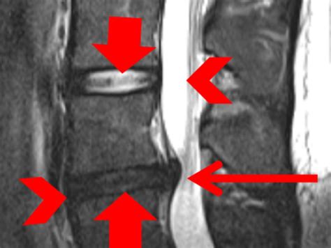 Lumbar Spine Mri Bulging Disc