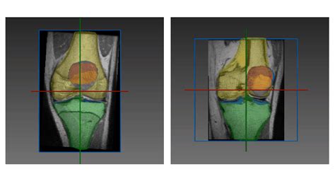 Rsip Vision Unveils New Articular Cartilage Segmentation Tool Odt