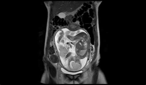 Fetal Brain Mri Localiser Mrimaster